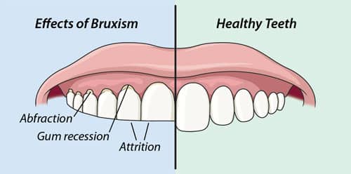 Abfraction Teeth