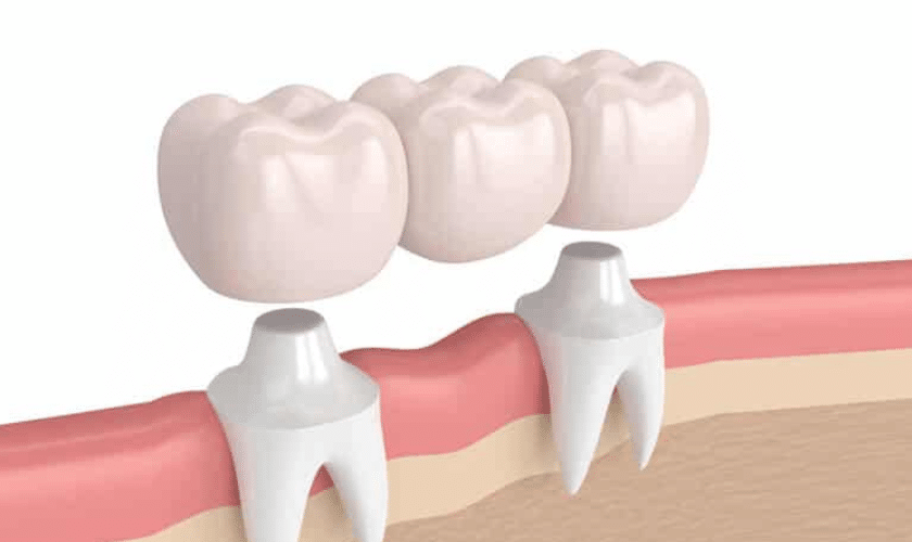 Revitalize Your Smile with Porcelain Bridges: An In-Depth Guide